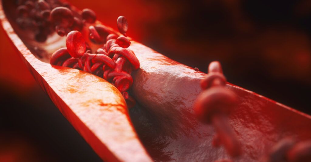 Στεφανιαία Νόσος: Συμπτώματα & Θεραπεία | Dr. Taleb