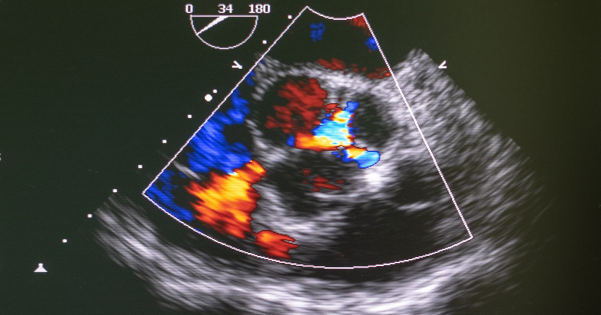 Τρίπλεξ Καρδιάς | Τι δείχνει και πως γίνεται | Dr. Taleb