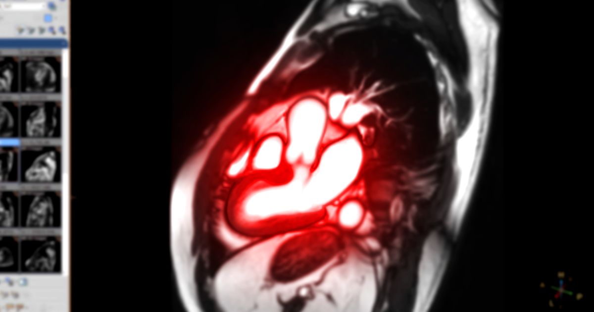 Μαγνητική Καρδιάς: Πώς γίνεται και πόσο κοστίζει;